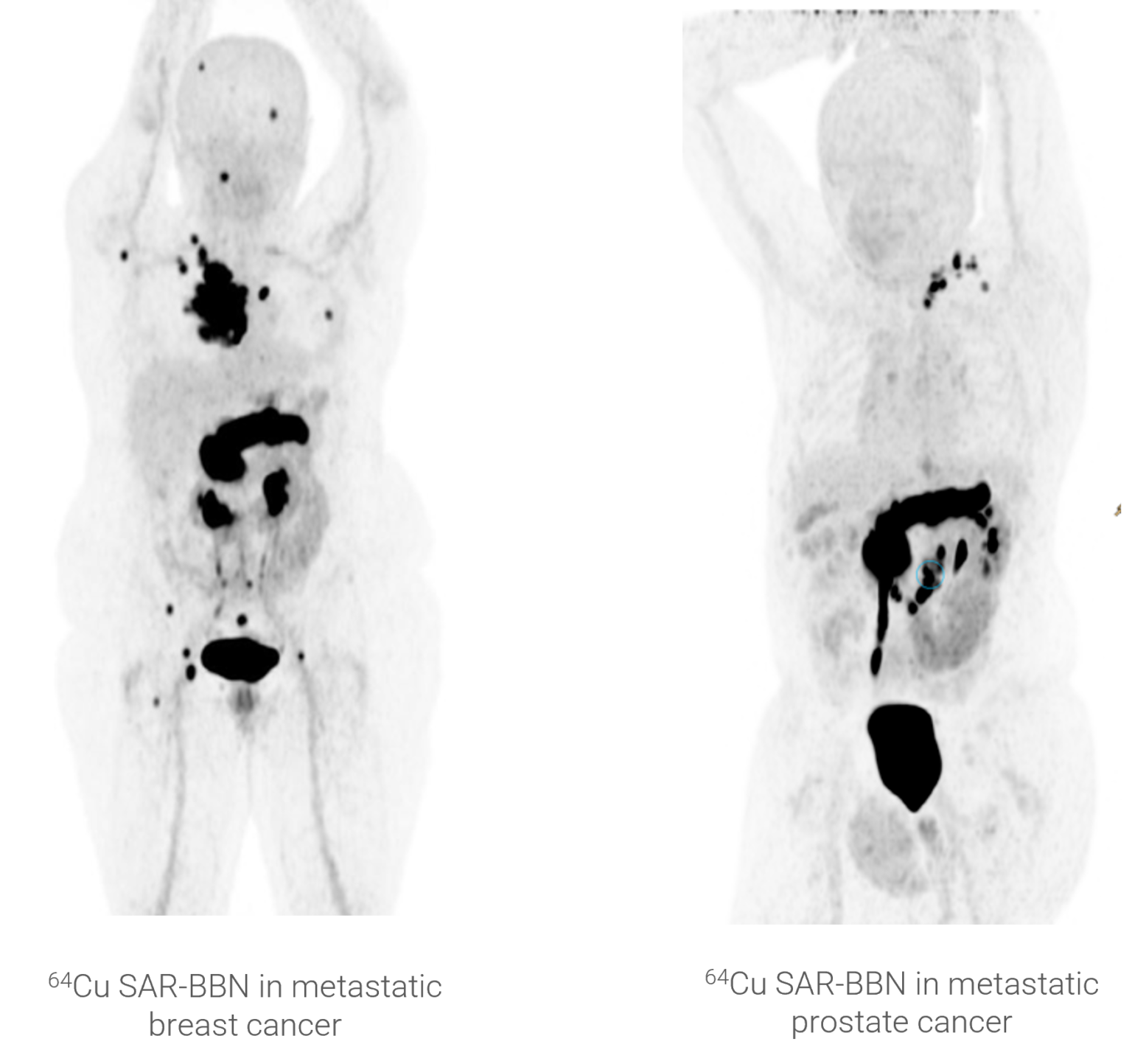 SAR-Bombesin - Next Generation, Highly Targeted Pan Cancer Target - Clarity